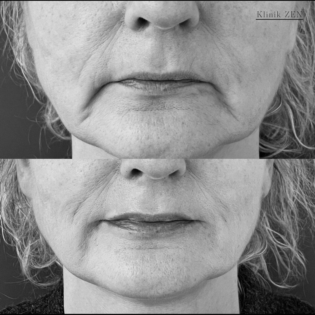 Rynke & Opstrammende behandling med Botox » Klinik ZEN