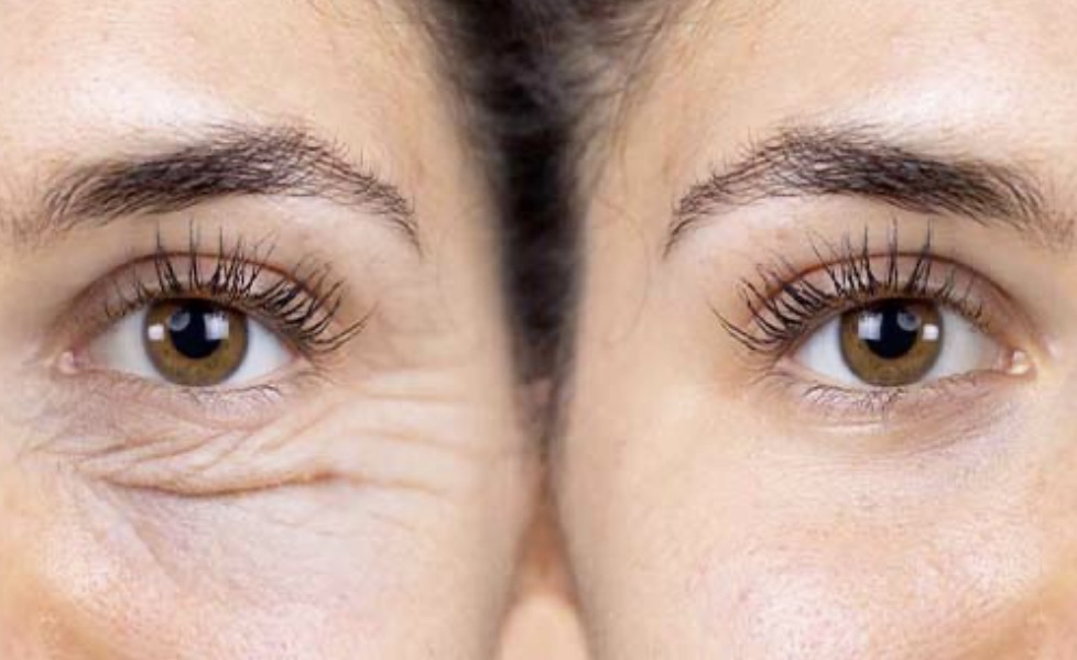 Klinik ZEN » CO2 laser behandling